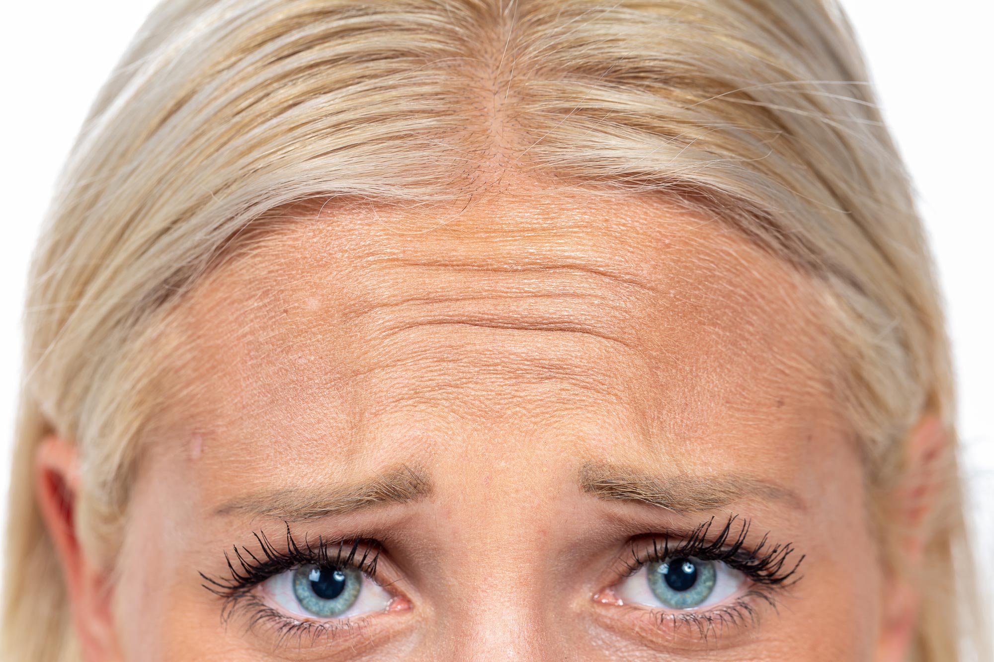 Forehead Line Treatment Worry Lines Amara Clinic Forehead Line Treatment Worry Lines Amara Clinic